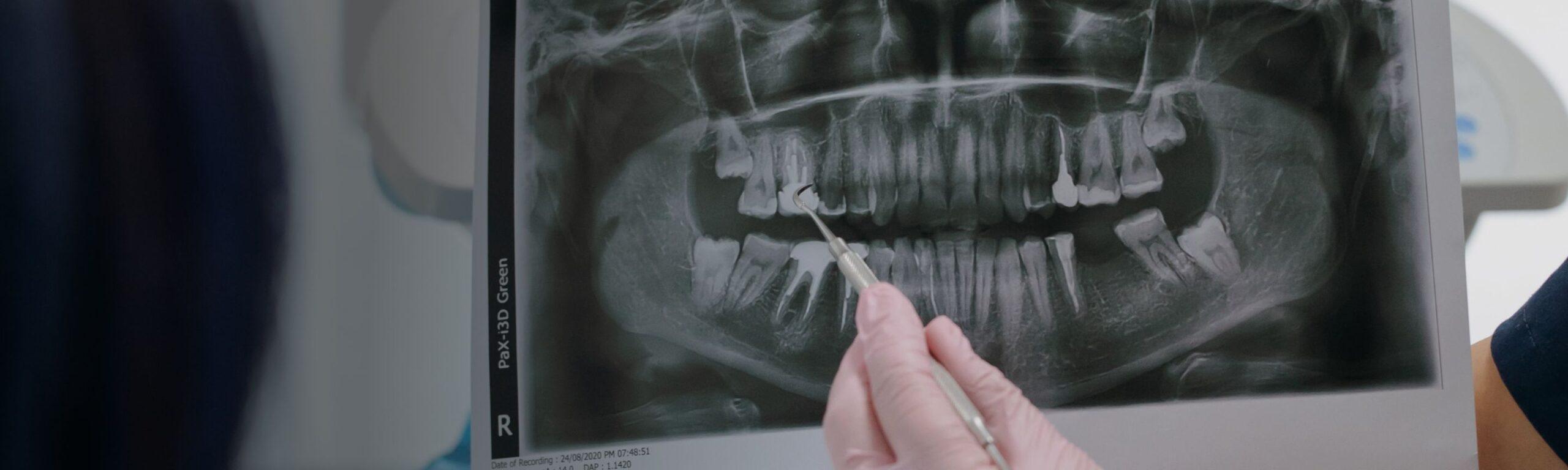 Root Canal Treatment Nieuwegein & Utrecht | Endodontic Care at DentalCity